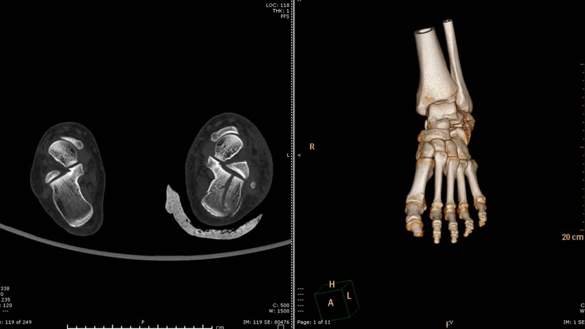 Ct Scan of Left Foot Stock Footage Video (100% Royalty-free) 1017921361 ...