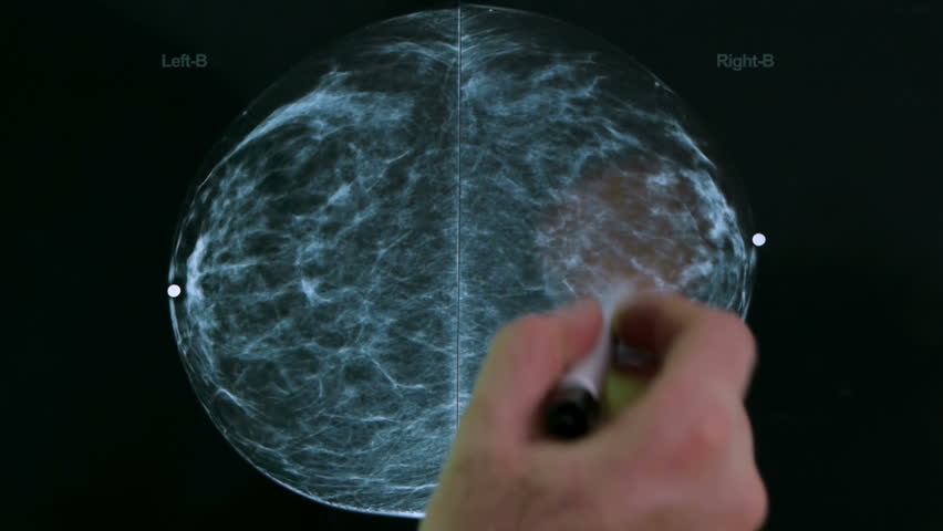 Mammogram X Ray Analysis (hd) Stock Footage Video (100% Royalty-free ...