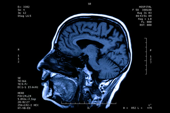Mri Headache Stock Footage Video (100% Royalty-free) 2970751 | Shutterstock